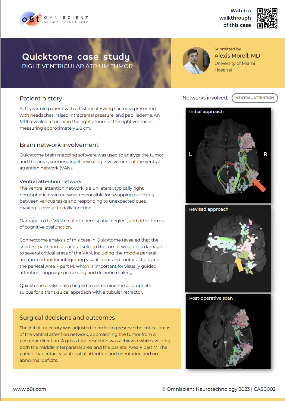 Right ventricular atrium tumor